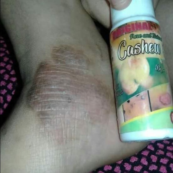 Cashew Oil | Makeup | Cashew Oil For Warts Skin Tag Kalugo Calluses ...